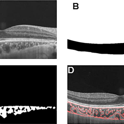 Progression Of Choroidal Image Binarization A The Original Ss Oct