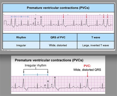 Premature Ventricular Contractions Ecg Fragmentation Of Ventricular