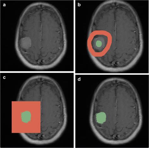 An Example Of A Semi Automated Segmentation Of A Right Frontal Grade I Download Scientific
