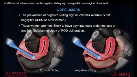 Uogjournal Video Abstract On The Negative Sliding Sign During Pelvic
