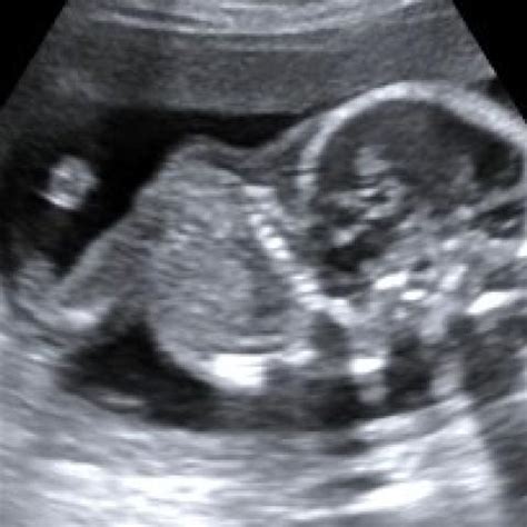 Iniencephaly Ultrasound