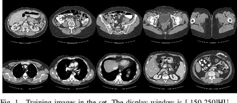 figure 1 from convolutional sparse coding for compressed sensing ct