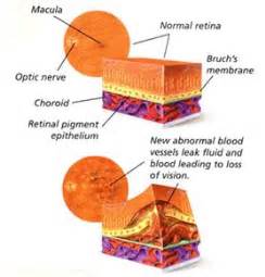 Explain On Stem Cell Treatment For AMD Assignment Point
