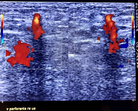 Venaseal® In Therapy Of Perforator Veins Cockett 23 Download