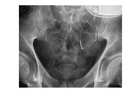 X Ray Of An Implanted Electrode And Neurostimulator Download Scientific Diagram