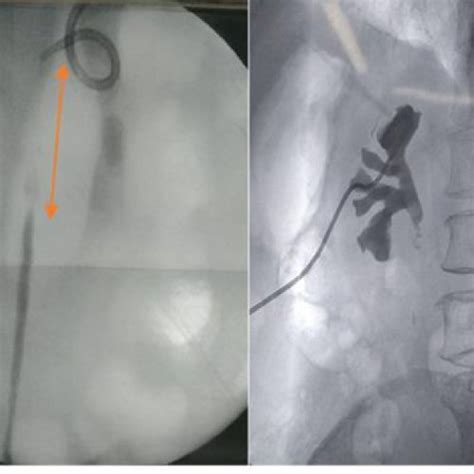 Retrograde And Antegrade Pyelogram Showing Long Left Upper Ureteric