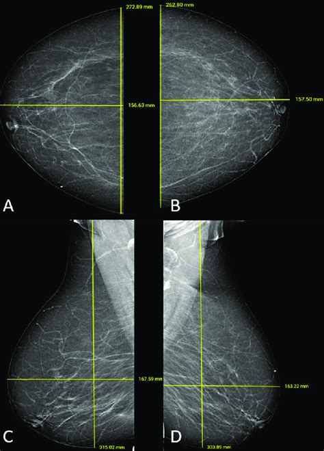 Breast Measurements A B Measurement Of Anteroposterior And
