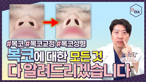 복코 교정 이렇게 해결합니다 복코 복코교정 복코성형 Youtube
