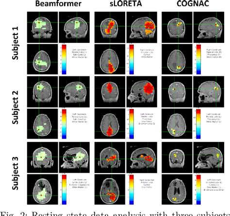 Figure 2 From A Novel Scanning Algorithm For Megeeg Imaging Using Covariance Partitioning And