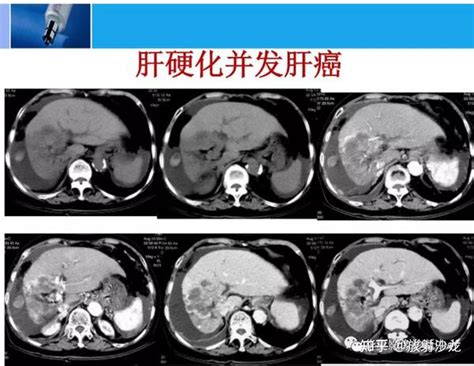 精华全篇：肝脏的ct影像诊断 知乎