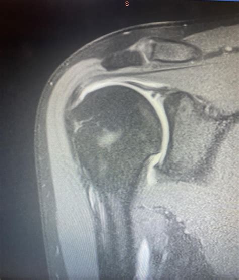 Labrum Tear R Rotatorcuff