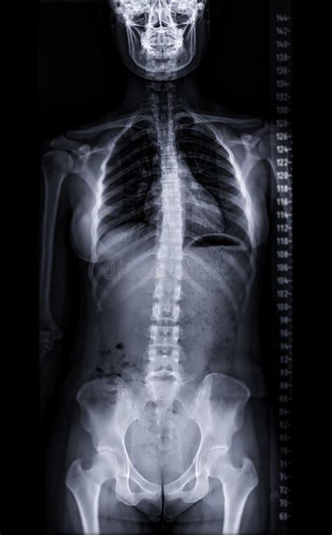 X Ray Image Of Whole Spine For Diagnosis Scoliosis Of Spine Stock