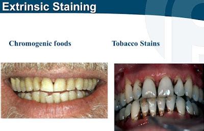 Dentist Best Dental Clinic In Vasundhara Tooth Stains Types Of Tooth Stains Causes