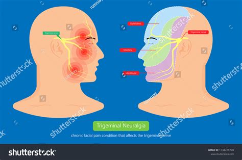 Trigeminal Neuralgia Art