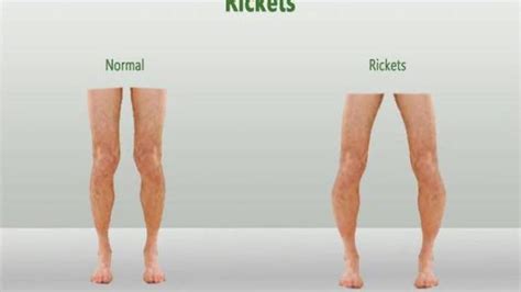 Diagnosis Of Rickets Medizzy