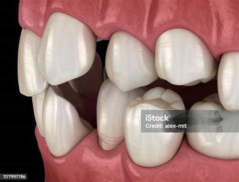비정상적인 치아 위치 치열 교정 개념 의학적으로 정확한 치아 3d 일러스트레이션 0명에 대한 스톡 사진 및 기타 이미지 0명 디자인 디지털 생성 이미지 Istock