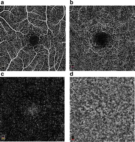 Macular Image Segmentation A Superficial Retina Capillary Plexus B