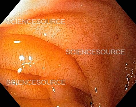 Normal Duodenum Endoscopic View Stock Image Science Source Images