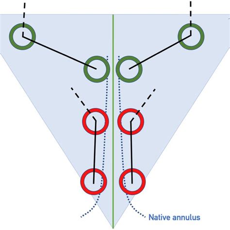 Position Of The Stitches On The Polytetrafluoroethylene Felt Pledget