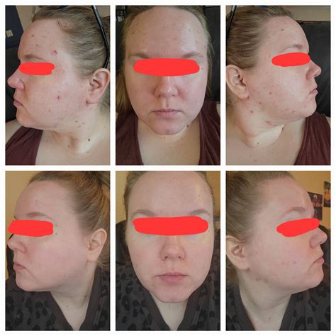 Tretinoin Spironolactone And Metronidazole Progress R Tretinoin