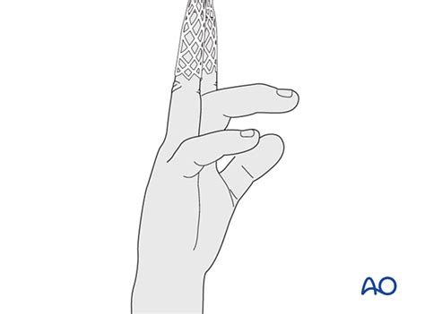 K Wire Fixation For Dislocation And Fracture Dislocation Of The Proximal Interphalangeal Joint