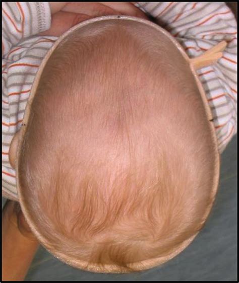 Pcm Photos Congenital Muscular Torticollis Cmt