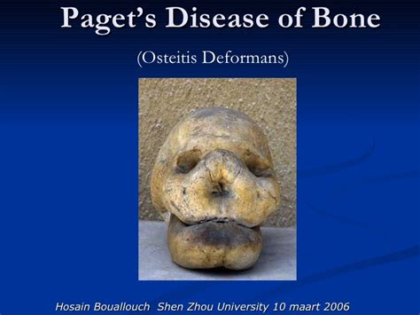 Pagets Disease Of Bone Mri At Philip Ayala Blog