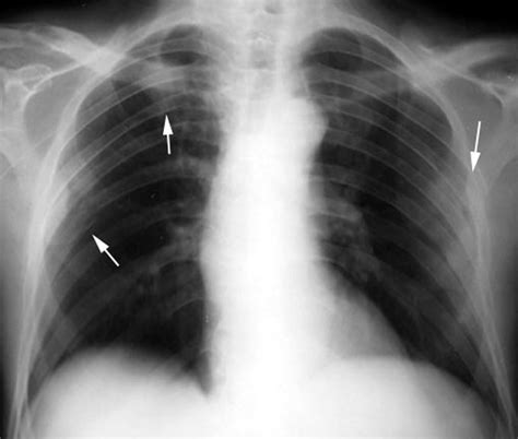 Метастазы В Легких На Рентгене Фото — Фото Картинки