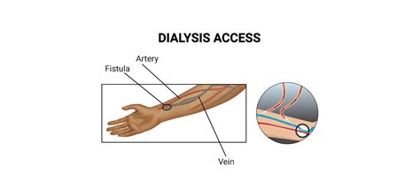 Types Of Dialysis Fistula And Access Explained