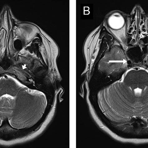 The Long Segment Of Stenosis But Not Occlusion Of The Left Internal Download Scientific