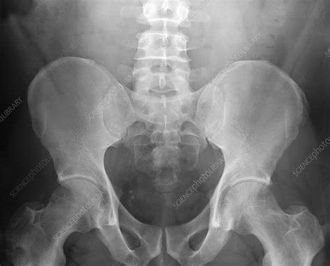 Pelvis Inlet X Ray At Ronnie Anderson Blog