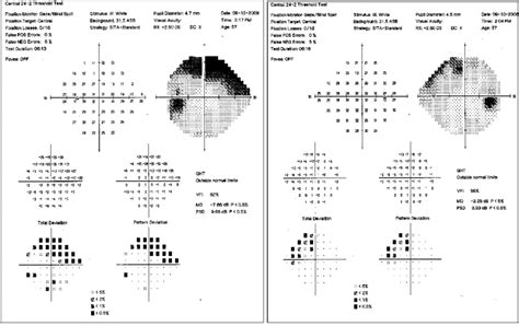 Figure Humphrey Visual Fields Sita Standard Central 242 Threshold Download Scientific Diagram