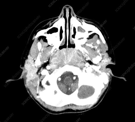 Mastoiditis And Abscess Ct Scan Stock Image C0271802 Science