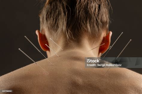 침술 바늘 및 건강 관리 근육 및 허리 통증 완화를 치료하는 신체 치료 환자 해부학 및 건식 니들링 물리 치료는 살롱에서 사람을 편안하게 하고 부상에 대한 전체적인 치료를