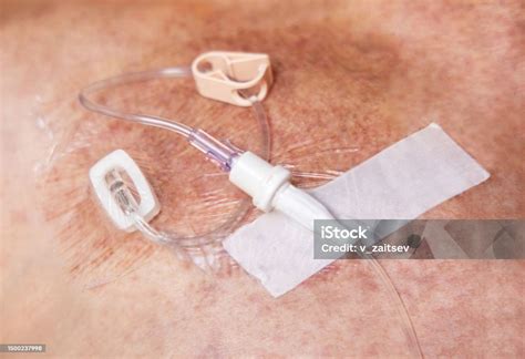 Tube For Intravenous Fluids Injections To Implantable Port For