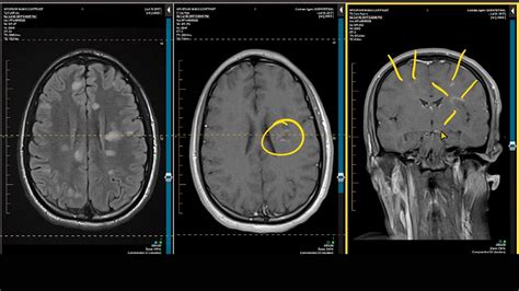 Ms Mri Brain Scan Results