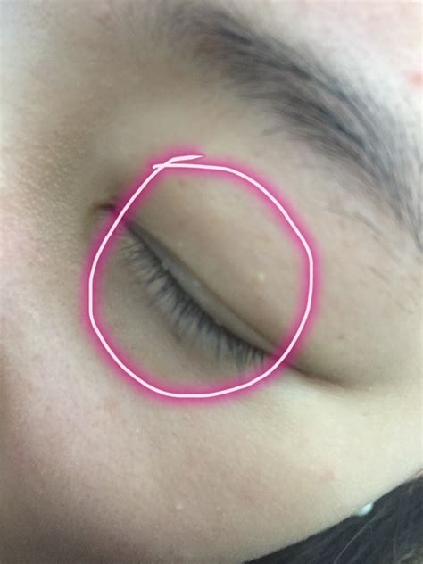 眼皮上长的扁平疣图片 眼皮上长了个肉色凸起 伤感说说吧