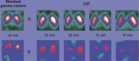 First Experience Datscan Imaging Using Cadmium Zinc Tellurid