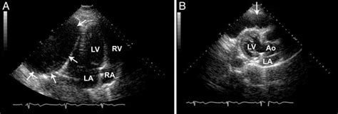Transthoracic Echocardiogram Of Patient 4 The Apical Four Chamber A
