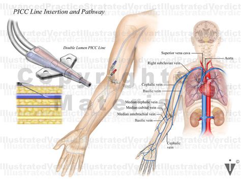 Stock IV Placement Complications Illustrated Verdict