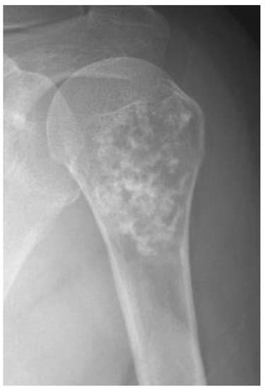 Classification Of Chondrosarcoma From Characteristic To Challenging