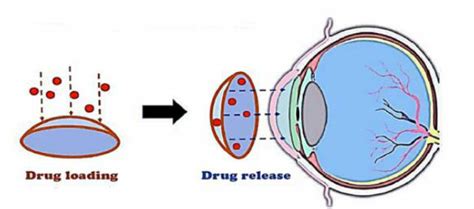 Drug Loaded Nanoparticles Implanted In Contact Lenses Are Used For Download Scientific Diagram