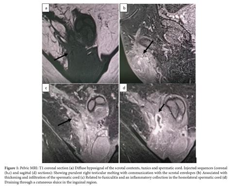 Recurrent Orchiepidydimitis Complicated By Purulent Melting Of The