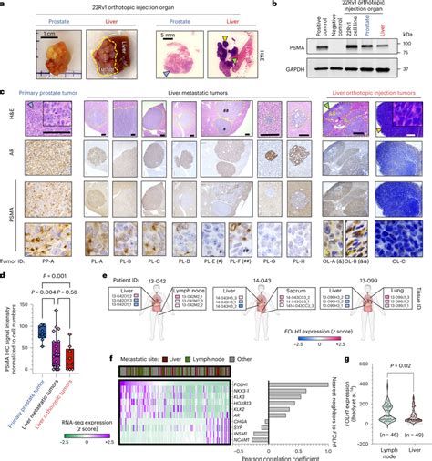 Intra Tumoral Heterogeneity Of Psma In Liver Lesions A Representative Download Scientific