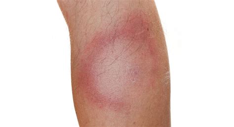 Ujed Krpelja Kod Dece Vađenje Krpelja I Kada Otići Kod Doktora Bebo