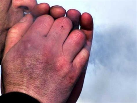 Осголт хөлдөлтөөс сэргийлье