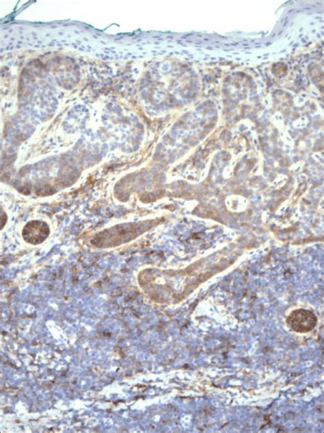 Simultaneous Expression Of Cd10 Within The Lymphocytes In Lymphoblastic
