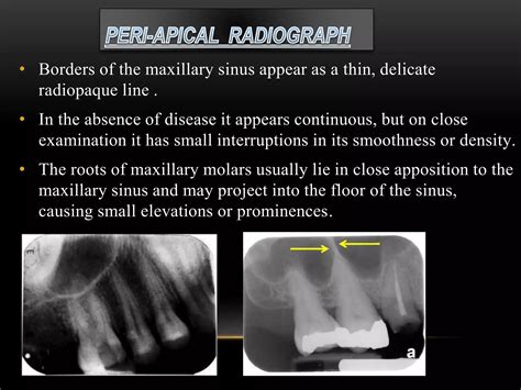 Maxillary Sinus Sinus Pptx