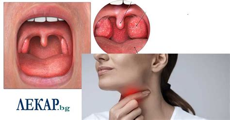Зачервено гърло Лечение с небет шекер и хапчета с антибиотик спрей