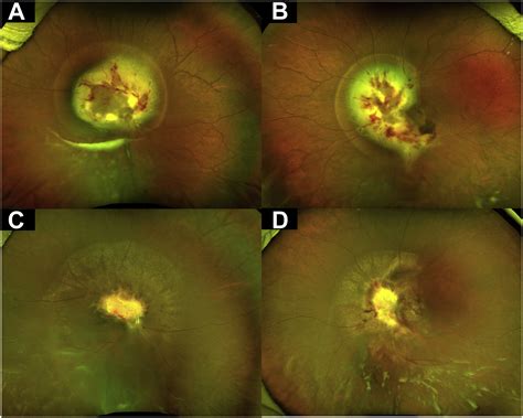 Mantle Cell Lymphoma With Bilateral Intraocular Involvement